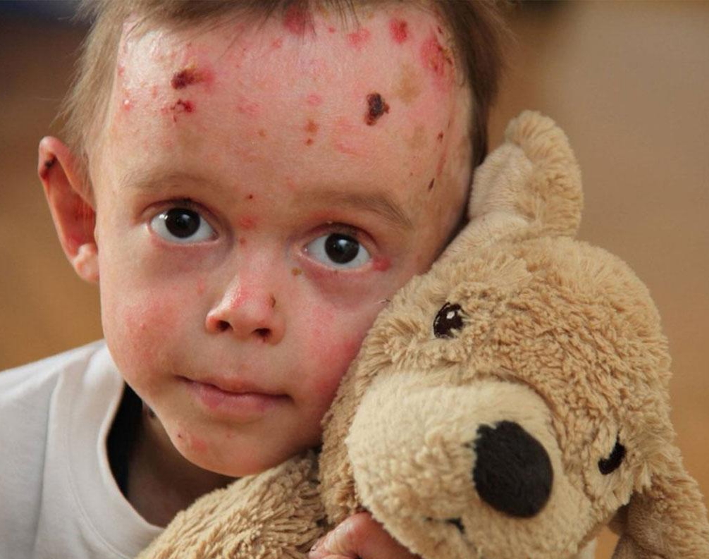 Supporting Children with Epidermolysis Bullosa | Giveth
